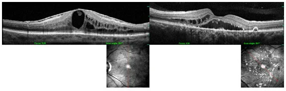 Optos OCT SLO Anterior Segment Lens